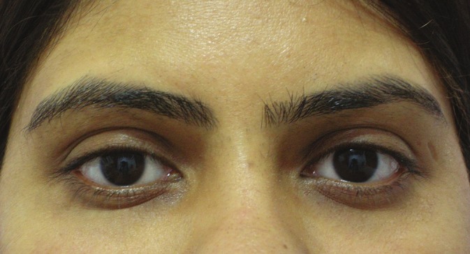 TEAR THROUGH RECOMMENDATIONS – The Indigo Clinic