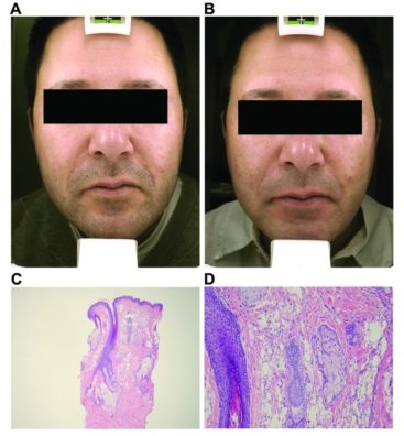 SILIKON 1000 AND GRANULOMAS (BIOPOLYMEROS AND ARTIFICIAL SILICONE SHOTS ...