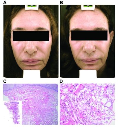 SILIKON 1000 AND GRANULOMAS (BIOPOLYMEROS AND ARTIFICIAL SILICONE SHOTS ...